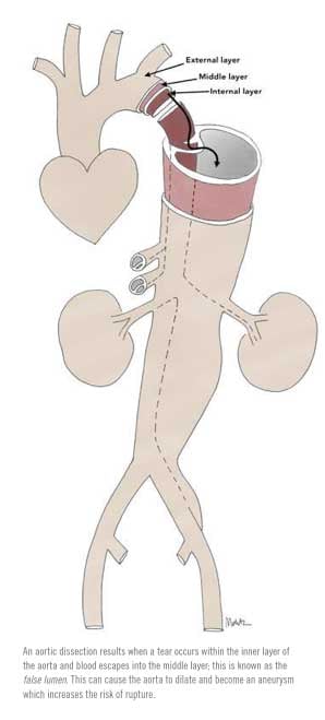 Acute Aortic Dissections